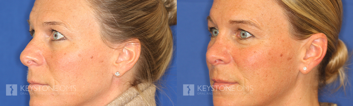 Rhinoplasty | Keystone OMS | Hermitage, PA
